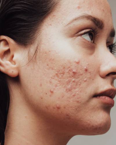 Acné Care | ClinicSkin